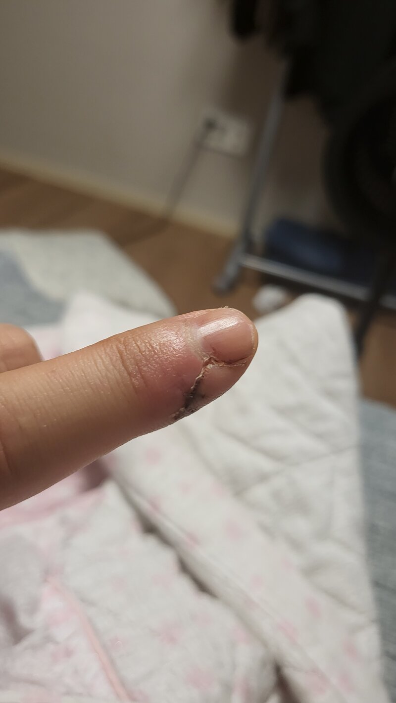 메이플스토리 인벤 약혐 손꾸락손가락에 감각없는거 요상함 기분 메이플스토리 인벤 자유게시판 구