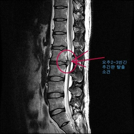 장기간 척추질환디스크추간판탈출치료에 대한 소회 오픈이슈갤러리 인벤